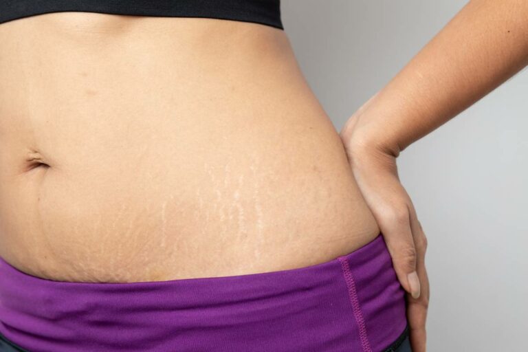 Do Stretch Marks Fade Over Time? - Cloud Med Spa Beverly Hills